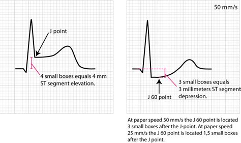 Ecg Interpretation Characteristics Of The Normal Ecg P Wave Qrs