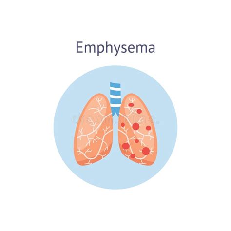 Emphysema Chronic Pulmonary Disease Diagram Vector Illustration