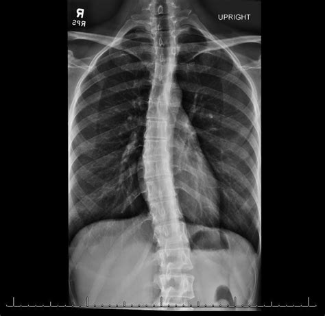 Scoliosis Diagnosis At 30yo Schroth Or Regular Pt R Scoliosis
