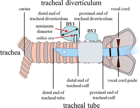 The Scheme Of Simulated Positional Relationships Between Tracheal