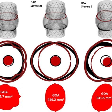 Tavr Expansion In Bav Subtypes According To The Sievers Download Scientific Diagram