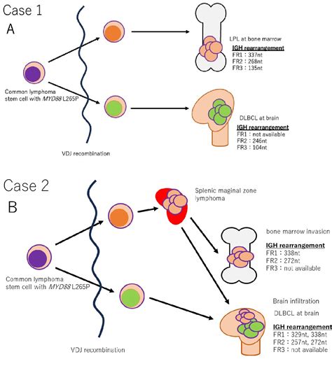 Figure 3 From Myd88 Mutation Positive Indolent B Cell Lymphoma With Cns