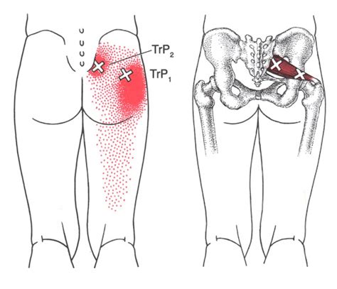 Chill Out Your Piriformis Trigger Points And Feel Better Theranub