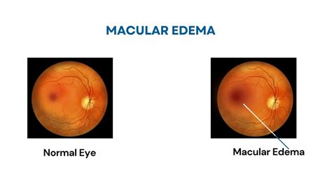 Normal Macula
