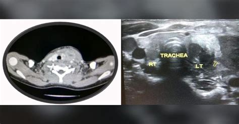 Diagnose Cause Of A Rare Thyroid Gland Related Presentation Showing