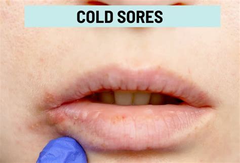 Cold Sores Pictures Of What They Look Like And Symptoms