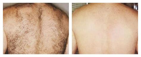 Laser Hair Removal Ottawa Advanced Laser Clinic