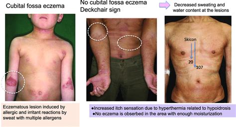 Clinical Features Of Ad With Or Without Cubital Fossa Eczema Adult Ad