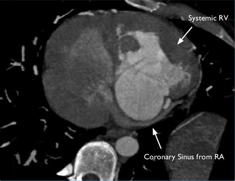 Ct Scan To Delineate The Anatomy Of The Coronary Sinus In A Patient