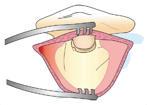 11 Obliteration Of The Middle Ear Subtotal Petrosectomy In