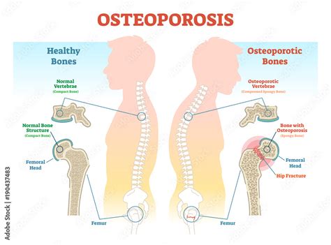 Osteoporosis Examples Vector Illustration Diagram With Bone Density Stock Vector Adobe Stock