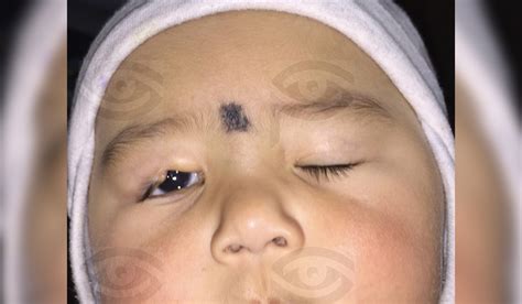 Birth Defects Dr Pallavi Singh Md Fico