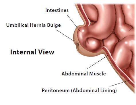 Congenital Hernia Of The Cord Newborn With Hernia Umbilical Cord A