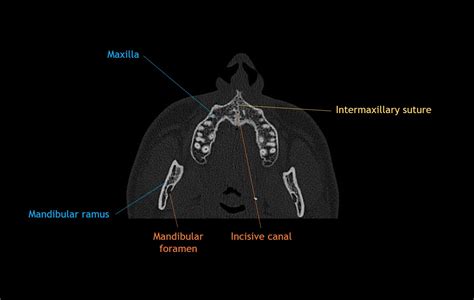 Face Bone Anatomy Ct
