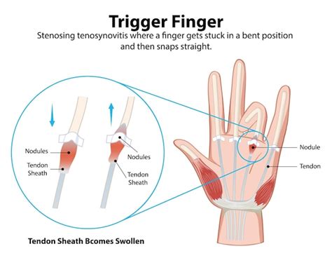 Finger Inflammation Vectors And Illustrations For Free Download