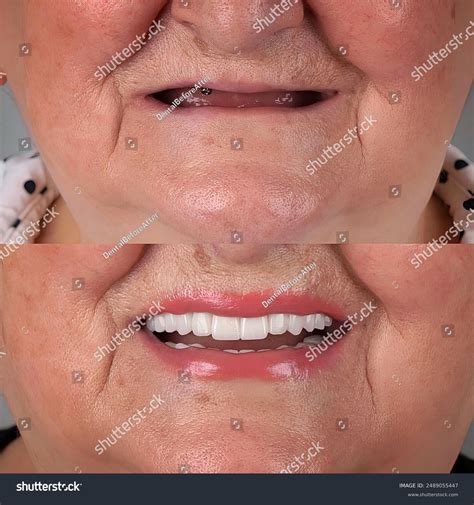108771 Smile Without Teeth With Teeth Before After Royalty Free Images