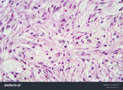 Hemosiderin Over 8 Royalty Free Licensable Stock Illustrations And Drawings Shutterstock