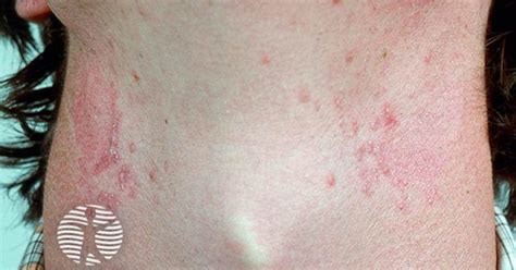 Elastosis Perforans Serpiginosa Image