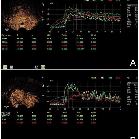 Ceus Tic In Patients With Pca The Extent Of Tumor Enhancement In A Download Scientific