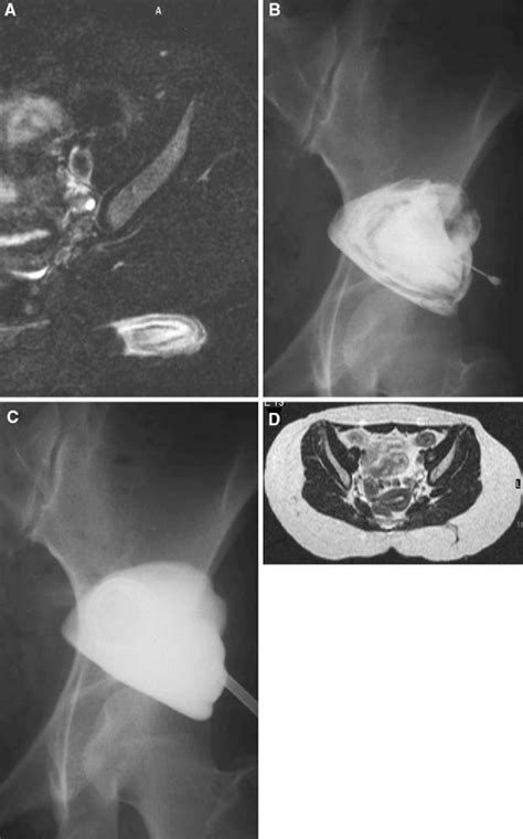 A 23 Year Old Woman With A Type Ii Hydatid Cyst In The Left Gluteal