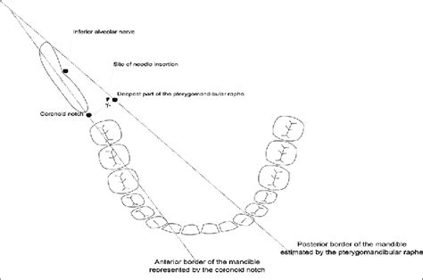 Inferior Alveolar Nerve Block Landmarks