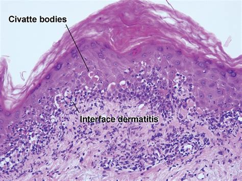 Interface Dermatitis Examples At Gwen Mayer Blog