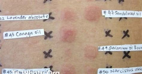 Positive Patch Tests To Essential Oils Image