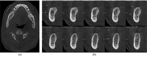 Advances In Radiographic Techniques Used In Dentistry Intechopen
