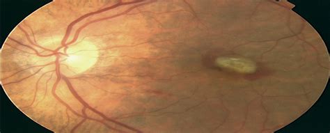 Radiation Maculopathy After Epimacular Brachytherapy For The Retinal Cases And Brief Reports
