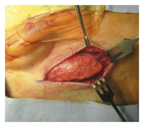 Right Postauricular Bulging Mass Which Is Asymptomatic Soft And