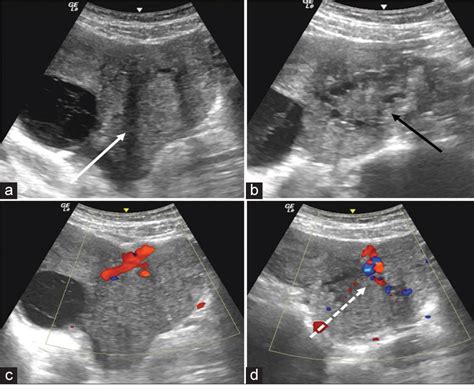 Serous Surface Papillary Borderline Tumor Of Ovary An Underdiagnosed