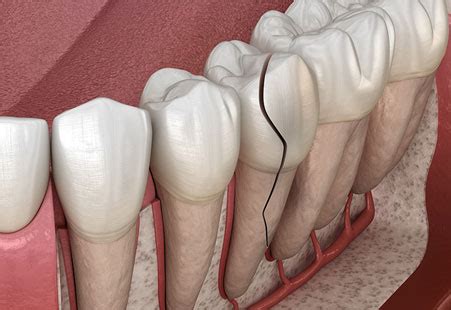Teeth Craze Lines Causes Treatments And 6 Ways To Prevent It