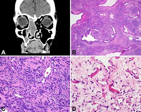 Biphenotypic Sinonasal Sarcoma A The Right Sided Tumor Involves The Download Scientific