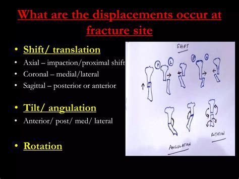 Fracture Classification Healing Pptx