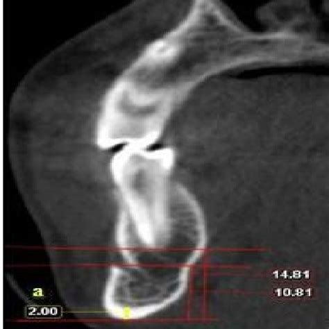 Cross Section Cut Of Cone Beam Computed Tomography Showing Panoramic Download Scientific