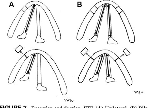 Table 2 From Type 3 Thyroplasty For Patients With Mutational Dysphonia