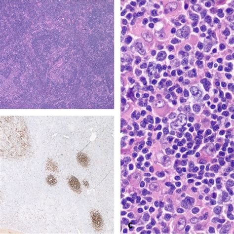 An Example Of Nodular Lymphocyte Predominant Hodgkin Lymphoma