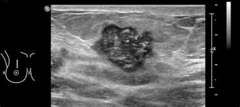 Mammography Masses Radiology Ucla Health