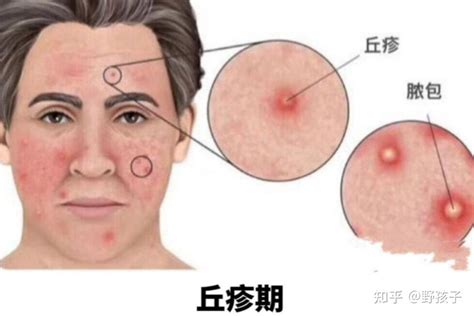 酒糟鼻三个阶段的图片 知乎