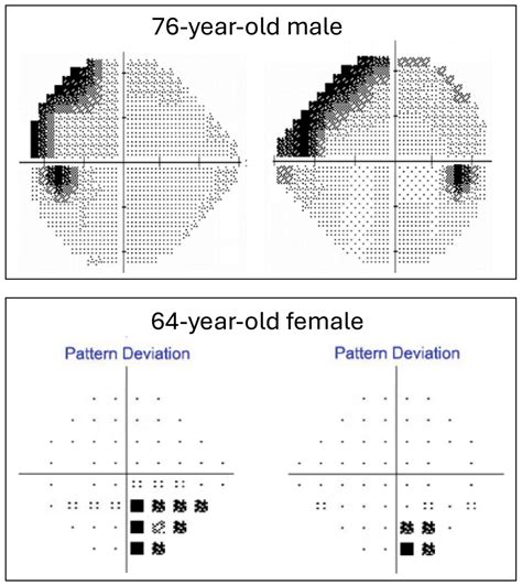 Visual Field Loss And Lesions Along The Visual Pathway