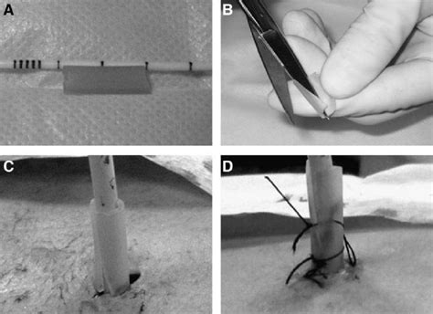 Reinforcement Of Nephrostomy Tube A The Rubber Drainage Tube Was Cut
