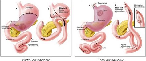 Gastrectomy Dr Sm Shahadat Hossain