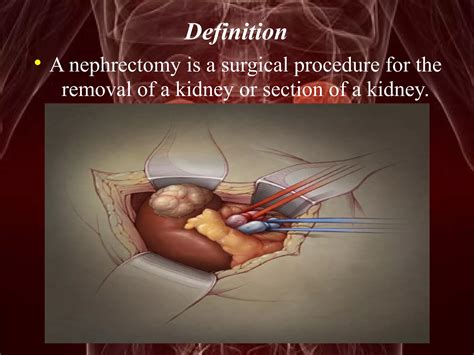 Nephrectomy Ppt