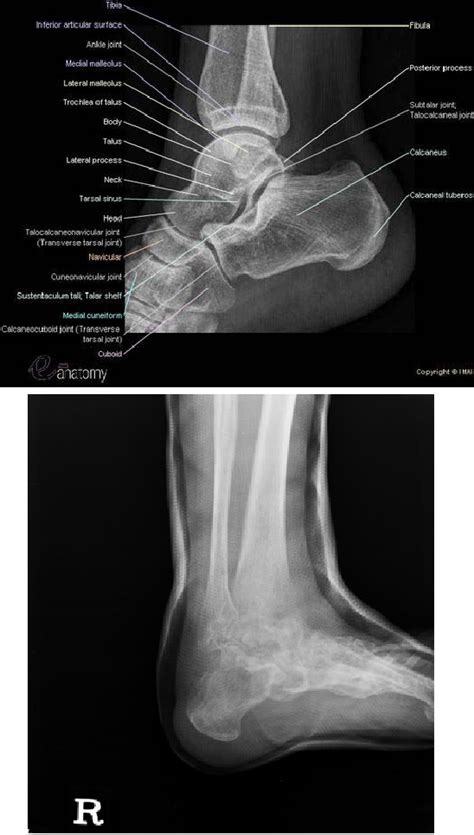 X Ray Calcaneus Ap View Positioning At Alana Tebbutt Blog