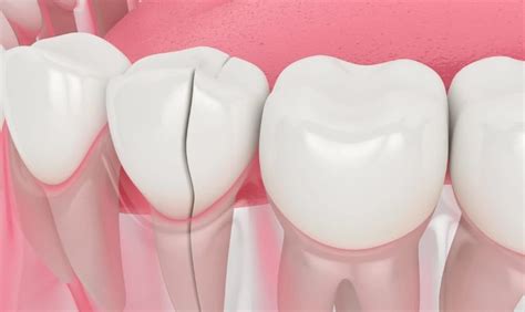 Broken Crown Repair Vs Replace Your Complete Guide