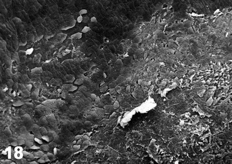 —a Class 4 Bladder Showing Extensive Necrosis With Exfoliation Of The