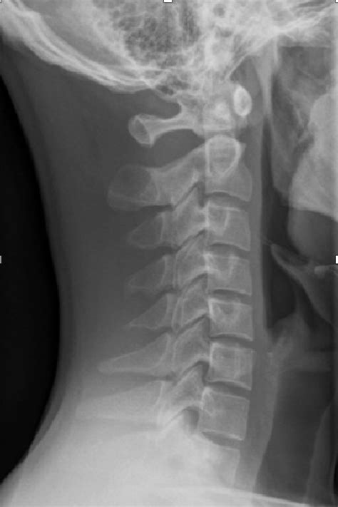 Diagram Of Lateral C Spine Quizlet