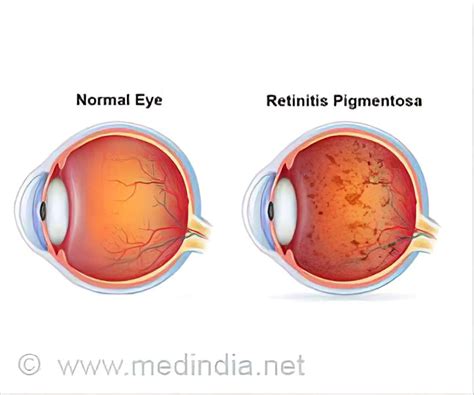 Retinitis Pigmentosa Calgary Eye Specialist