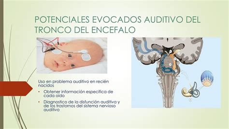 Potenciales Evocados Auditivo Del Tronco Del Encef Nory Timaure Udocz