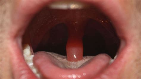 Uvula Surgery